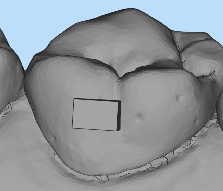 Clear Aligner Attachments Explained: Enhancing Orthodontic Treatment