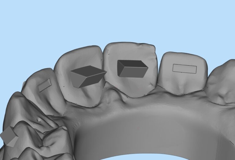 Clear Aligner Attachments Explained: Enhancing Orthodontic Treatment