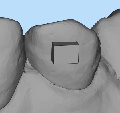 Clear Aligner Attachments Explained: Enhancing Orthodontic Treatment