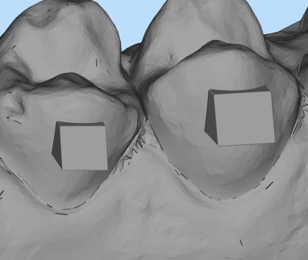 Clear Aligner Attachments Explained: Enhancing Orthodontic Treatment