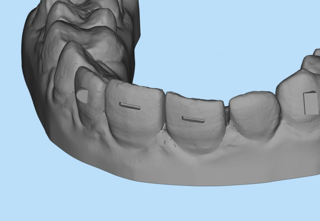 Power Ridges: Enhancing Clear Aligner Treatment for Better Results