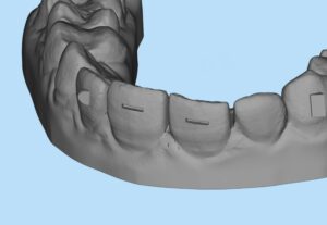 Power Ridges: Enhancing Clear Aligner Treatment for Better Results